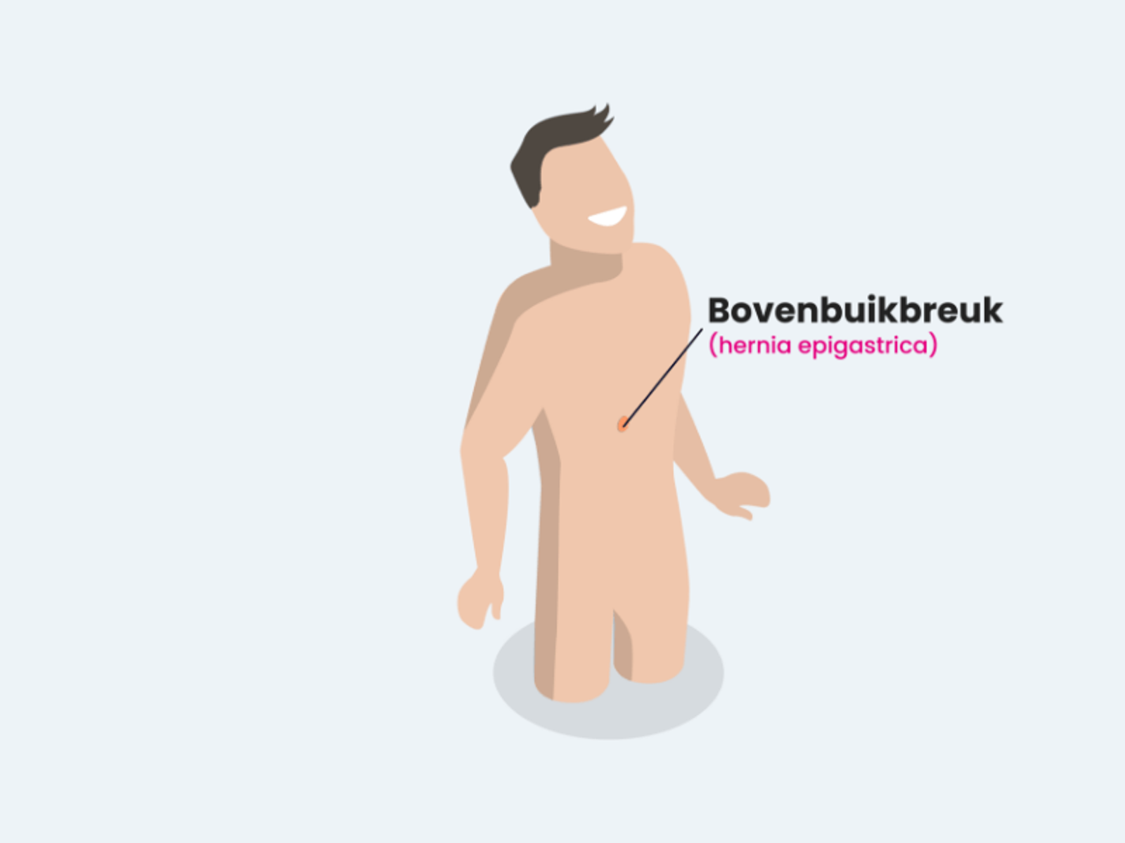 Bovenbuikbreuk operaties bij het HIN | veilig herstel