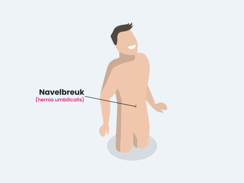 Navelbreuk Behandelen | ervaren specialisten - Het HIN